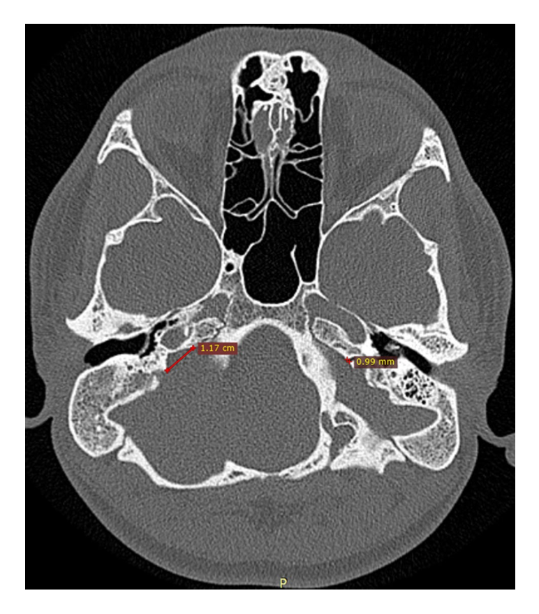 Large cochlear aqueduct - Dizziness-Doctor.com