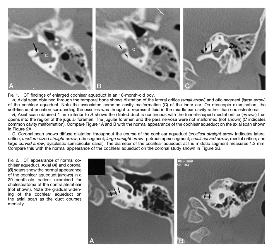 Large cochlear aqueduct - Dizziness-Doctor.com