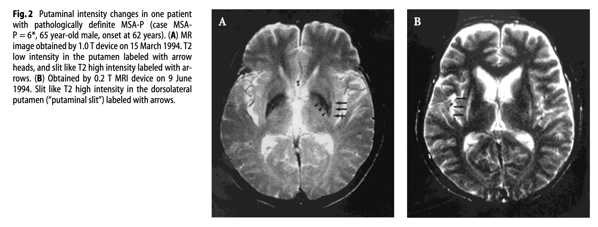 Multiple system atrophy - Dizziness-Doctor.com